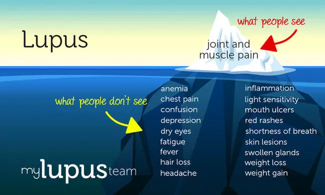 Lupus: What People Don't See (Infographic) | MyLupusTeam