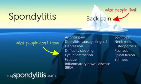 Spondylitis and Numbness or Weakness in Legs | MySpondylitisTeam