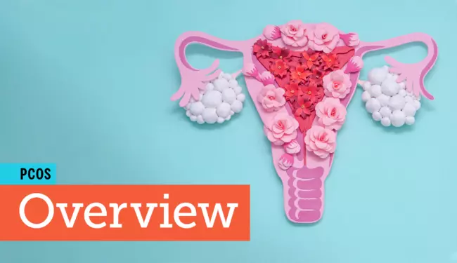 PCOS – An Overview | myPCOSteam