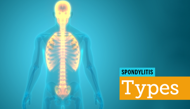 Your Guide to Spondylitis: Symptoms, Treatments, and More ...
