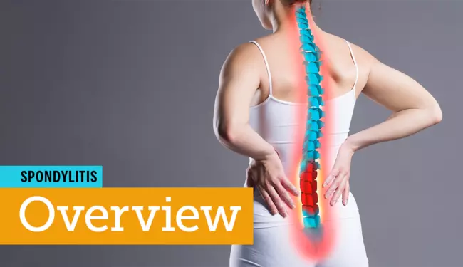 What Is Spondylitis? Understanding Ankylosing Spondylitis ...
