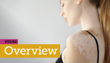 Your Guide to Vitiligo: Symptoms, Treatments, and More | MyVitiligoTeam
