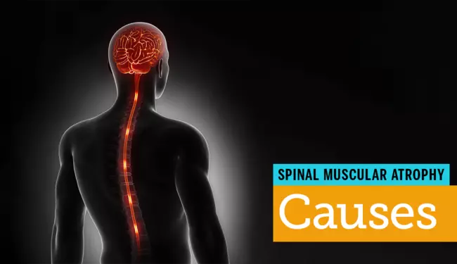 Causes of Spinal Muscular Atrophy | mySMAteam