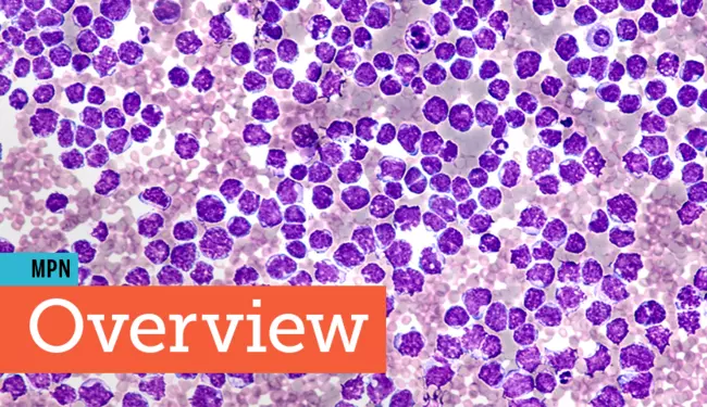 Myeloproliferative Neoplasms (MPNs) — An Overview | myMPNteam