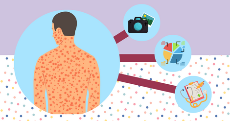 Leukemia Rash and Bruises: Pictures and Symptoms | MyLeukemiaTeam