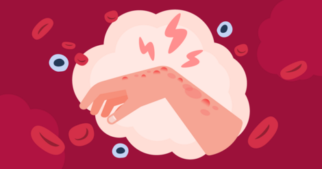 CLL Stages: What Living With Stages 0-4 Is Like | MyLeukemiaTeam