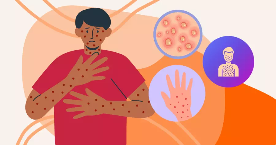 What Does a Crohn’s Rash Look and Feel Like? Photos and Treatments ...