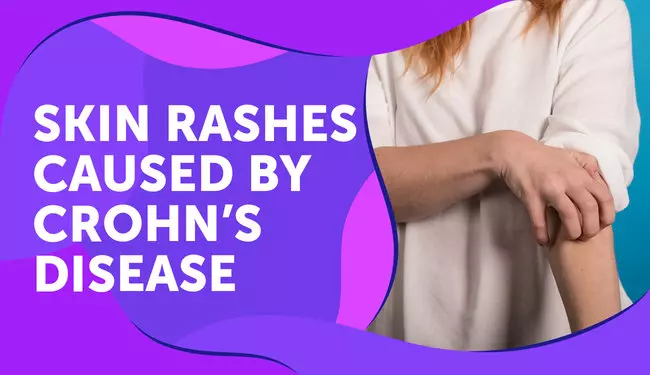 Rashes are a common occurrence for people with Crohn’s disease ...