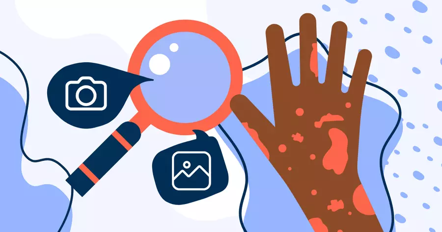 Skin Rashes With Ulcerative Colitis: What Do They Look Like? Pictures ...