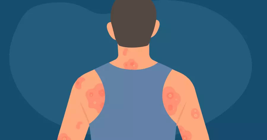 Guttate Psoriasis: Causes, Symptoms, and Treatments | MyPsoriasisTeam