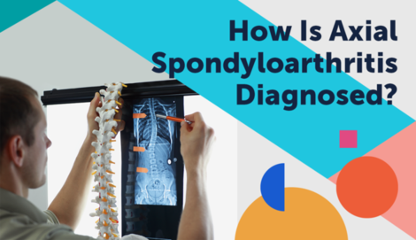 Early Symptoms of Spondylitis | MySpondylitisTeam