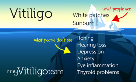 Vitiligo and Vision Loss: What’s the Connection? | MyVitiligoTeam