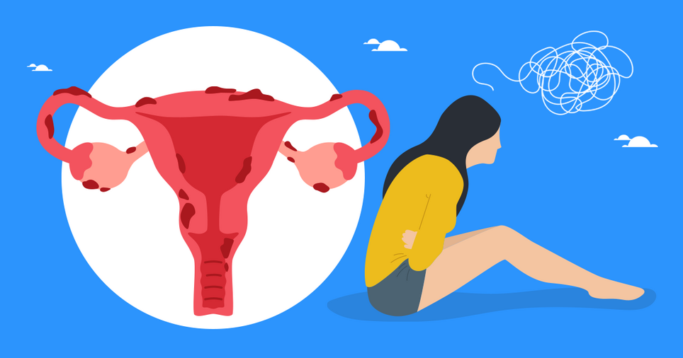 Treating Endometriosis | MyEndometriosisTeam