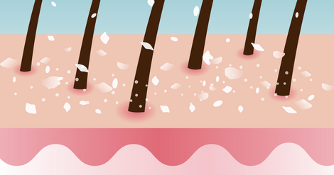 Inverse Psoriasis vs. Intertrigo: Understanding the Symptoms ...