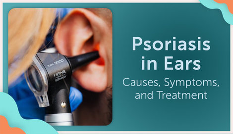 Ear Psoriasis Treatment