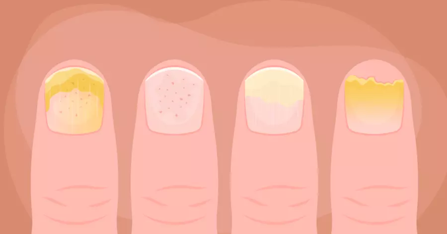Psoriatic Arthritis and Nails: Ridges, Pitting, and More Symptoms ...