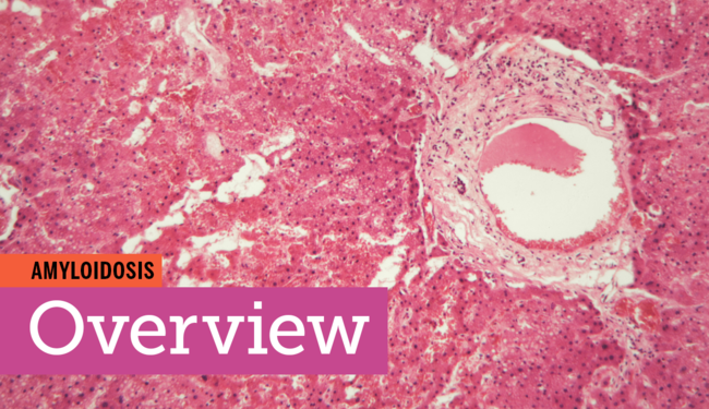Your Guide to Amyloidosis: Symptoms, Treatments, and More ...