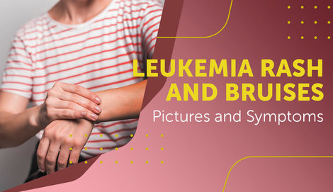 Signs and Symptoms of Chronic Lymphocytic Leukemia | MyLeukemiaTeam