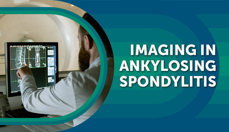 Spondylitis and Numbness or Weakness in Legs | MySpondylitisTeam
