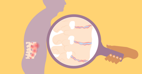 Foot and Heel Pain With Ankylosing Spondylitis: 5 Ways To Relieve ...