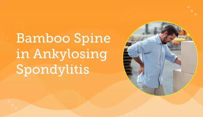 Bamboo Spine in Ankylosing Spondylitis | MySpondylitisTeam
