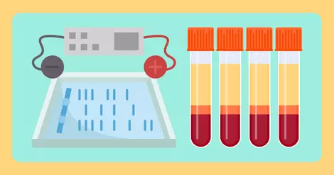 Immunofixation Serum Interpretation Mm