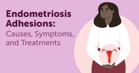 Managing Endometriosis Flare-Ups | MyEndometriosisTeam