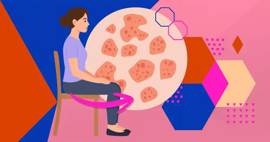 HS on the Buttocks: Managing Lesions, Sitting, and More | myHSteam
