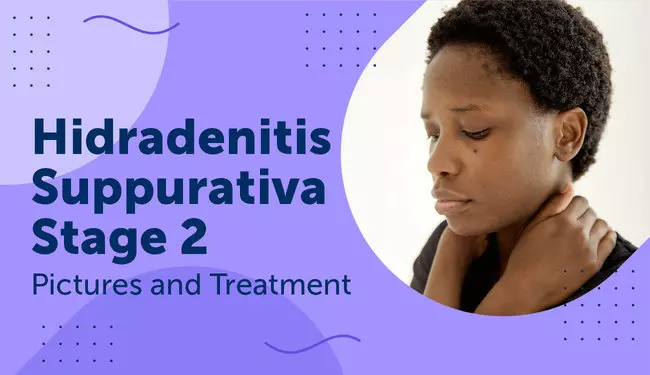 Hidradenitis Suppurativa Stage 2: Pictures and Treatment | myHSteam