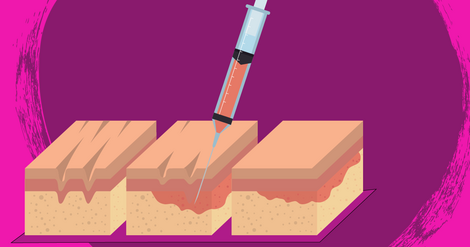 3 Types of Infusion Treatments for Ulcerative Colitis ...