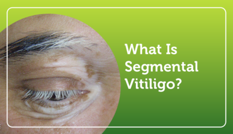 Full-Body Vitiligo: Diagnosis and Treatment | MyVitiligoTeam