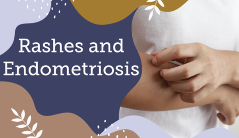 Endometriosis and Lupus: What’s the Connection? | MyEndometriosisTeam