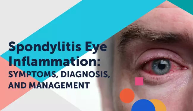 Spondylitis Eye Inflammation: Symptoms, Diagnosis and Management ...