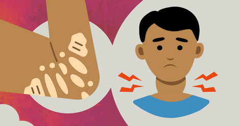 Psoriasis on the Nose: 5 Key Facts and Treatment Tips | MyPsoriasisTeam