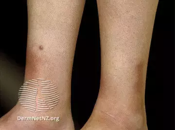 Skin Rashes You Can Get With Ulcerative Colitis | MyCrohnsAndColitisTeam