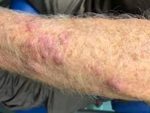 What Does Prurigo Nodularis Look Like? Pictures for Reference ...