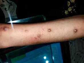 What Does Prurigo Nodularis Look Like? Pictures for Reference ...