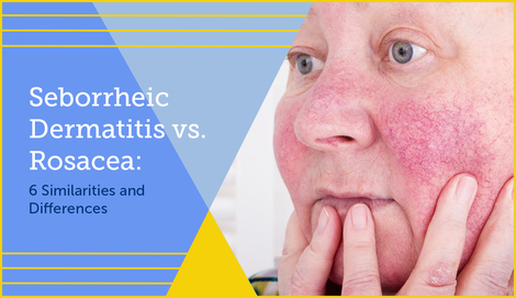 What Is Seborrheic Dermatitis? Understanding the Skin Condition ...