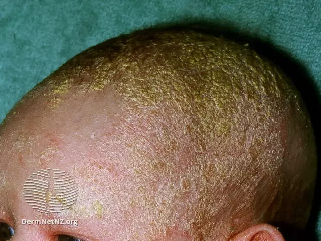 3 Seborrheic Dermatitis Symptoms in Infants To Watch Out for ...