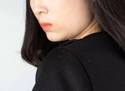 Seborrheic Dermatitis on the Scalp: Scabs, Oil, Pimples, and More ...