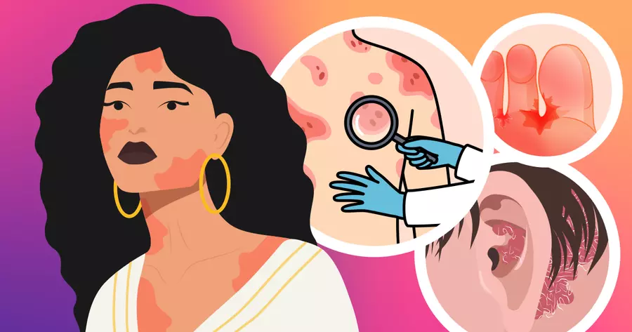 Psoriasis vs. Fungal Infections: Photos and Differences in Symptoms ...