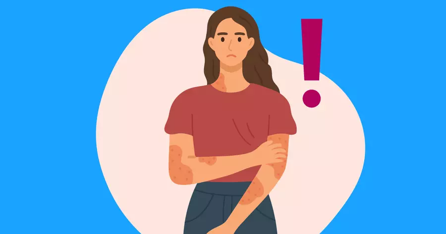 Psoriasis vs. Lupus: Photos and Signs To Tell the Difference ...