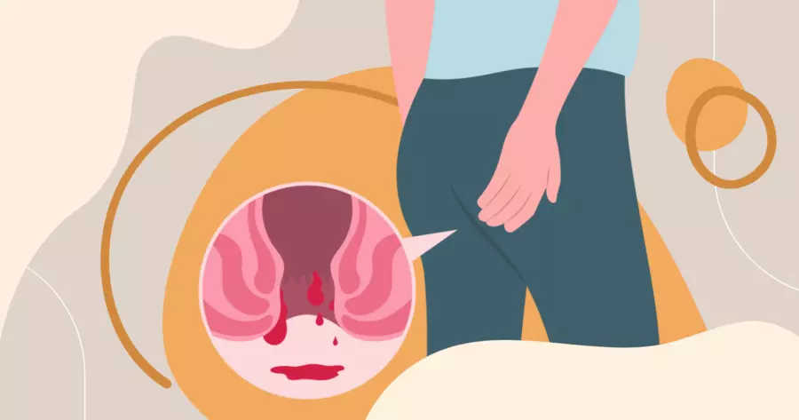 Ulcerative Colitis and Hemorrhoids: 4 Things To Know ...