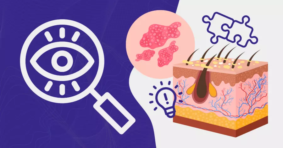 Psoriasis vs. Shingles: Reference Photos and Differing Signs ...