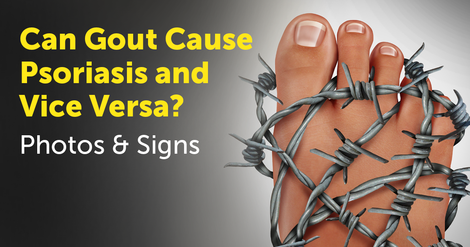 Psoriasis on Lips: Pictures, 4 Ways To Treat It, and More | MyPsoriasisTeam