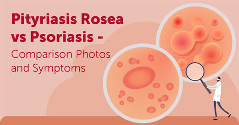 Psoriasis vs. Ringworm: What's the Difference? | MyPsoriasisTeam