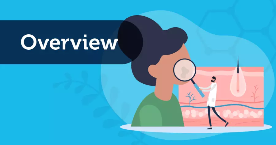 What Is Seborrheic Dermatitis? Understanding the Skin Condition ...