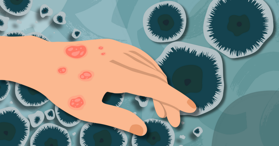 Psoriasis General Information | MyPsoriasisTeam