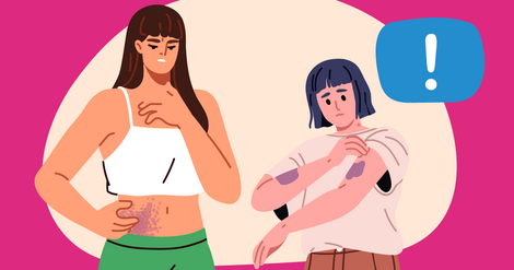Psoriasis in the Belly Button: Symptoms and Treatment | MyPsoriasisTeam