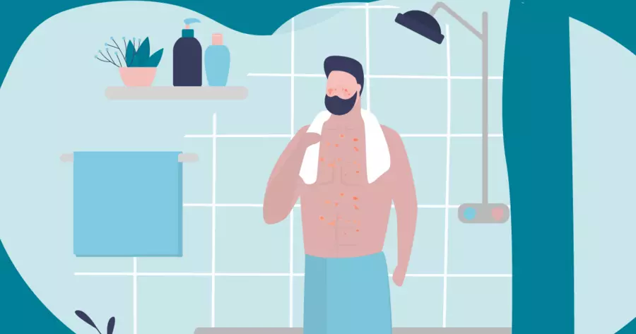 6 Tips for Managing Lupus Rash After Showers | MyLupusTeam